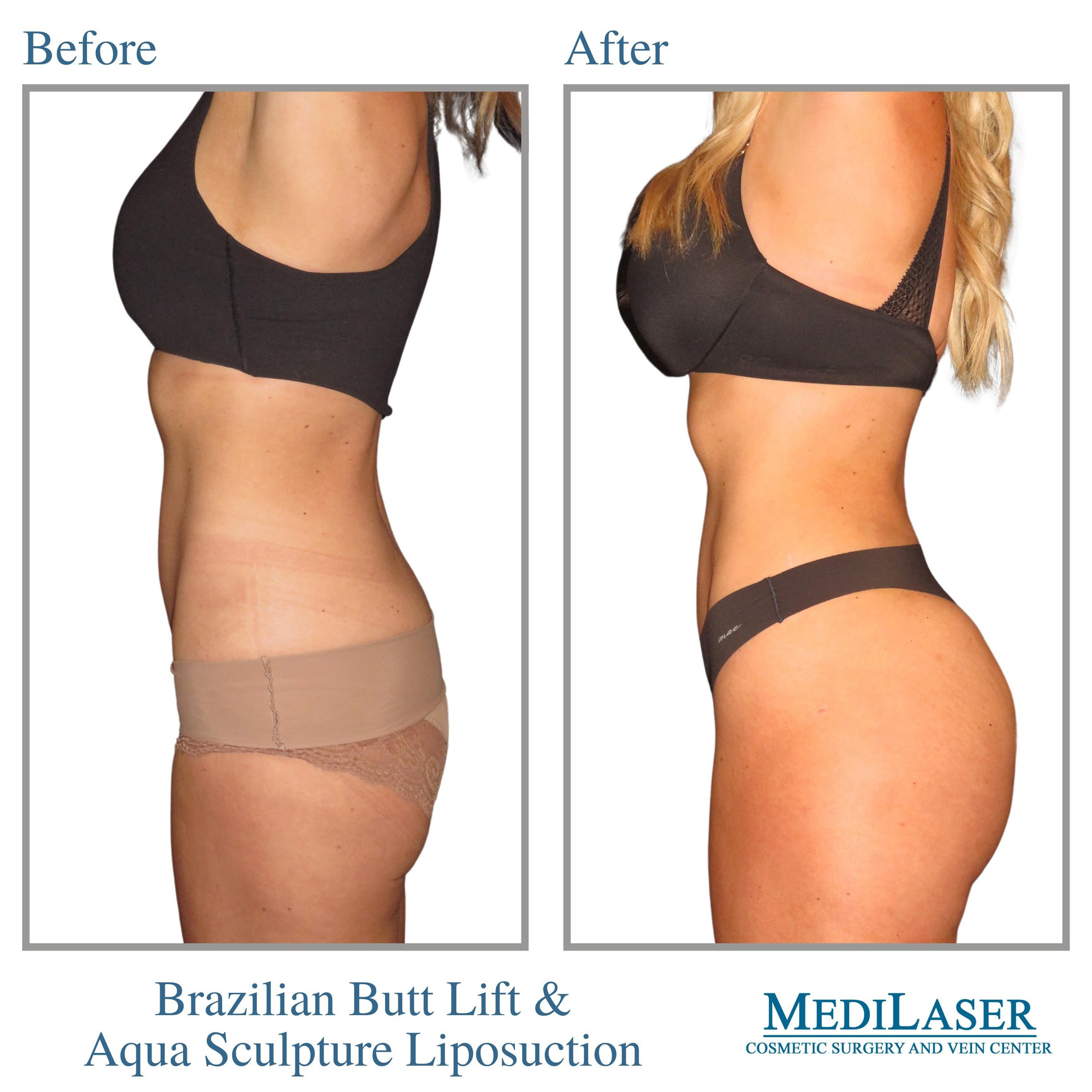 BBL Before & After | Medilaser | Frisco, TX