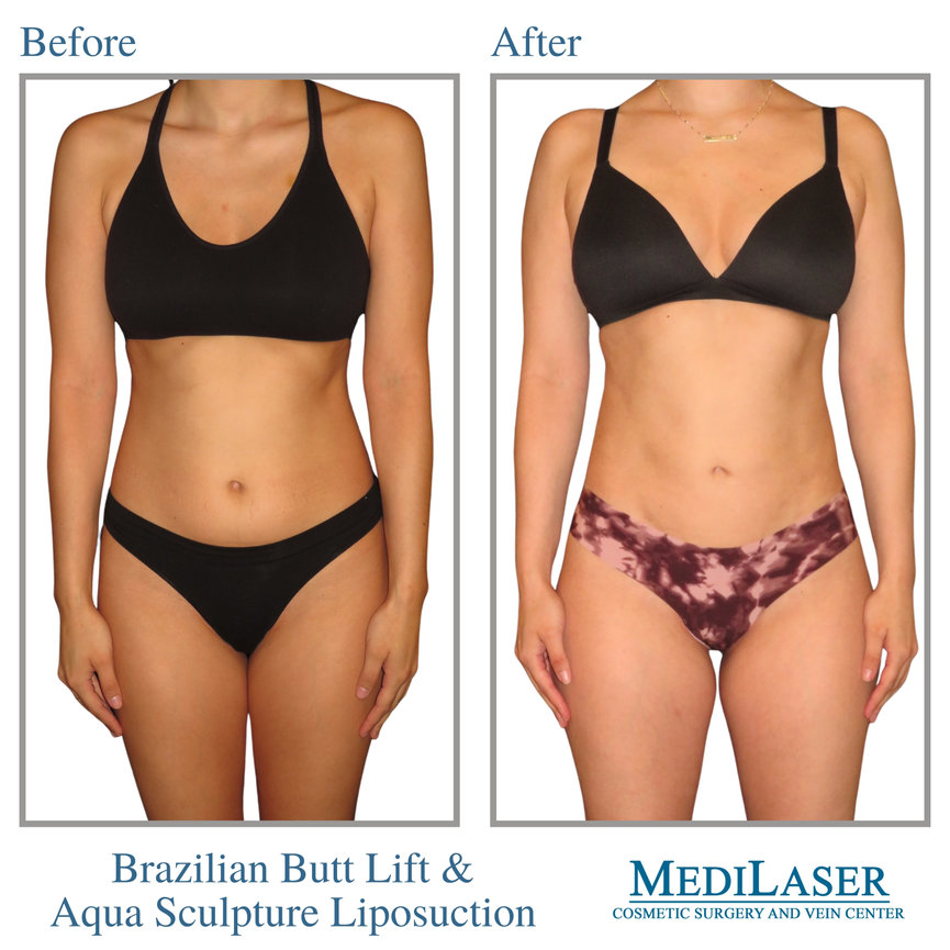 Brazilian Butt Lift Before and After - Medilaser Surgery and Vein Center